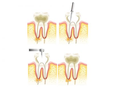 Root Canal Therapy in Downtown Calgary - CORE Dental